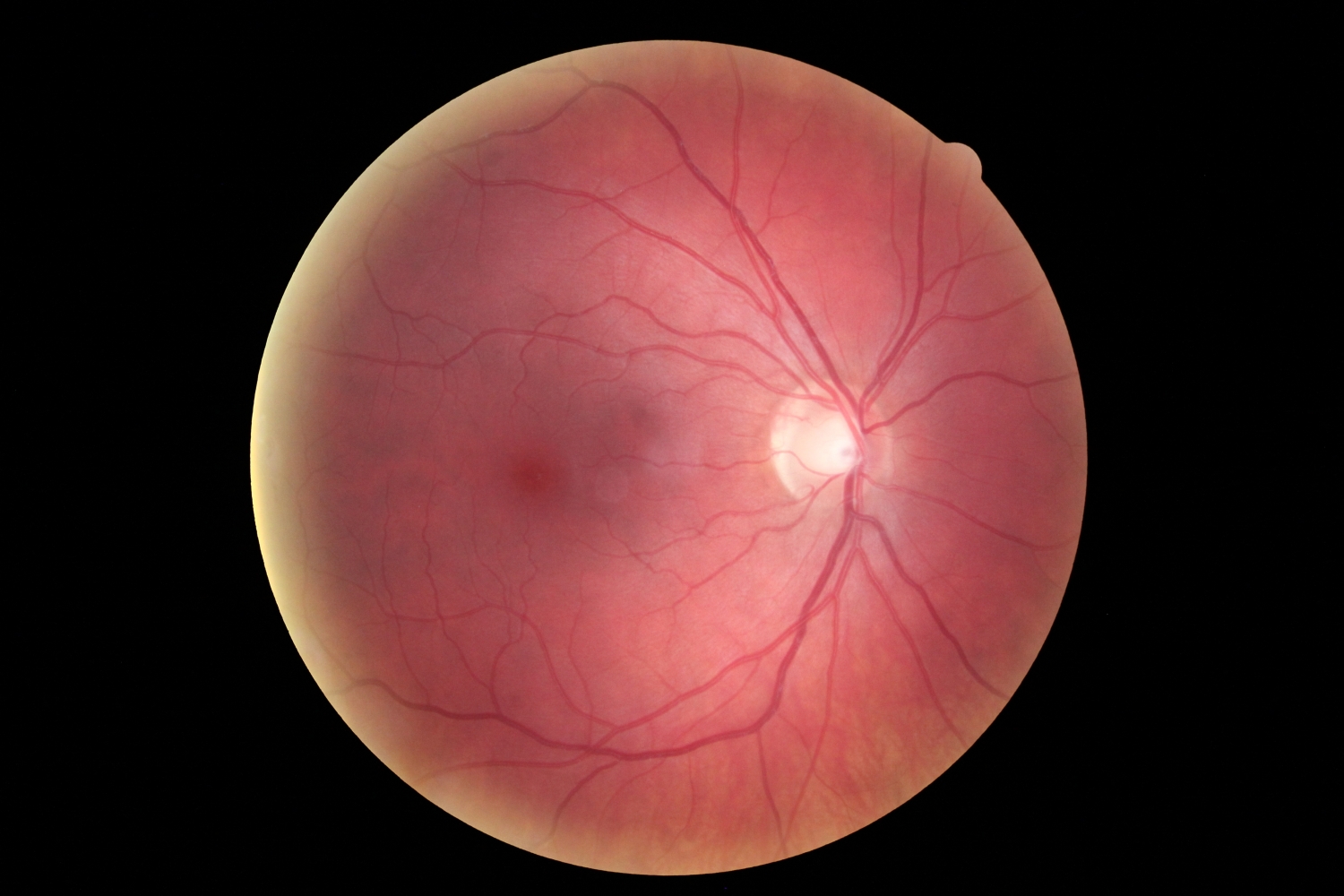 Retinal Images: Why Are They So Important?! - Asheville Optometrists ...